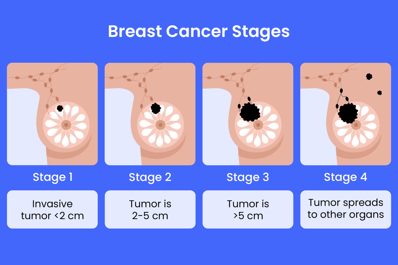 Understanding the Stages of Breast Cancer: A Comprehensive Guide ...